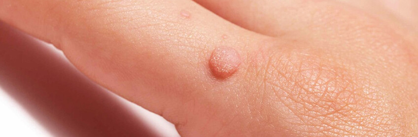 Zelf (steel)wratten verwijderen? Lees hoe u dit gemakkelijk kunt ...